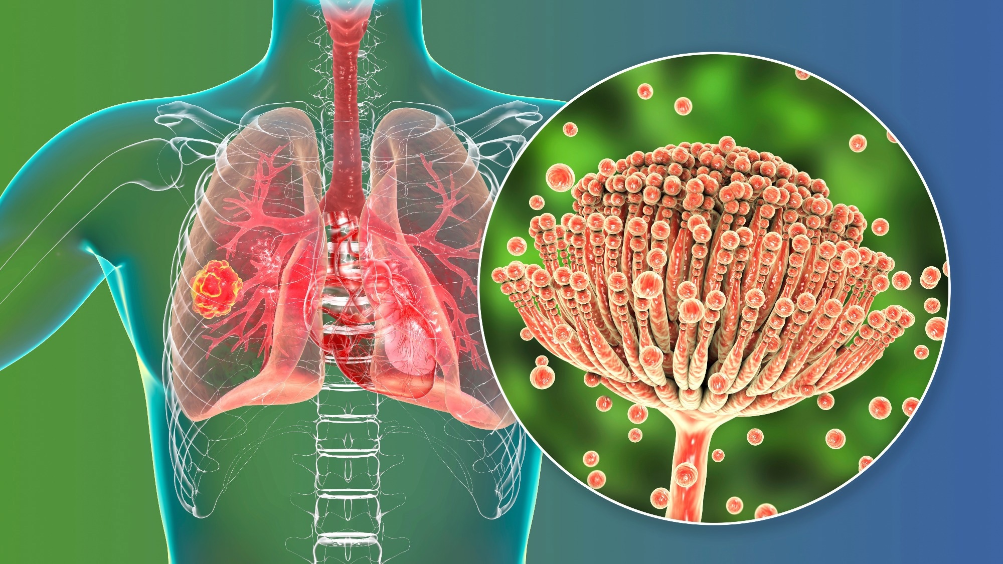 Une étude présente de rares cas d'aspergillose pulmonaire associée au ...