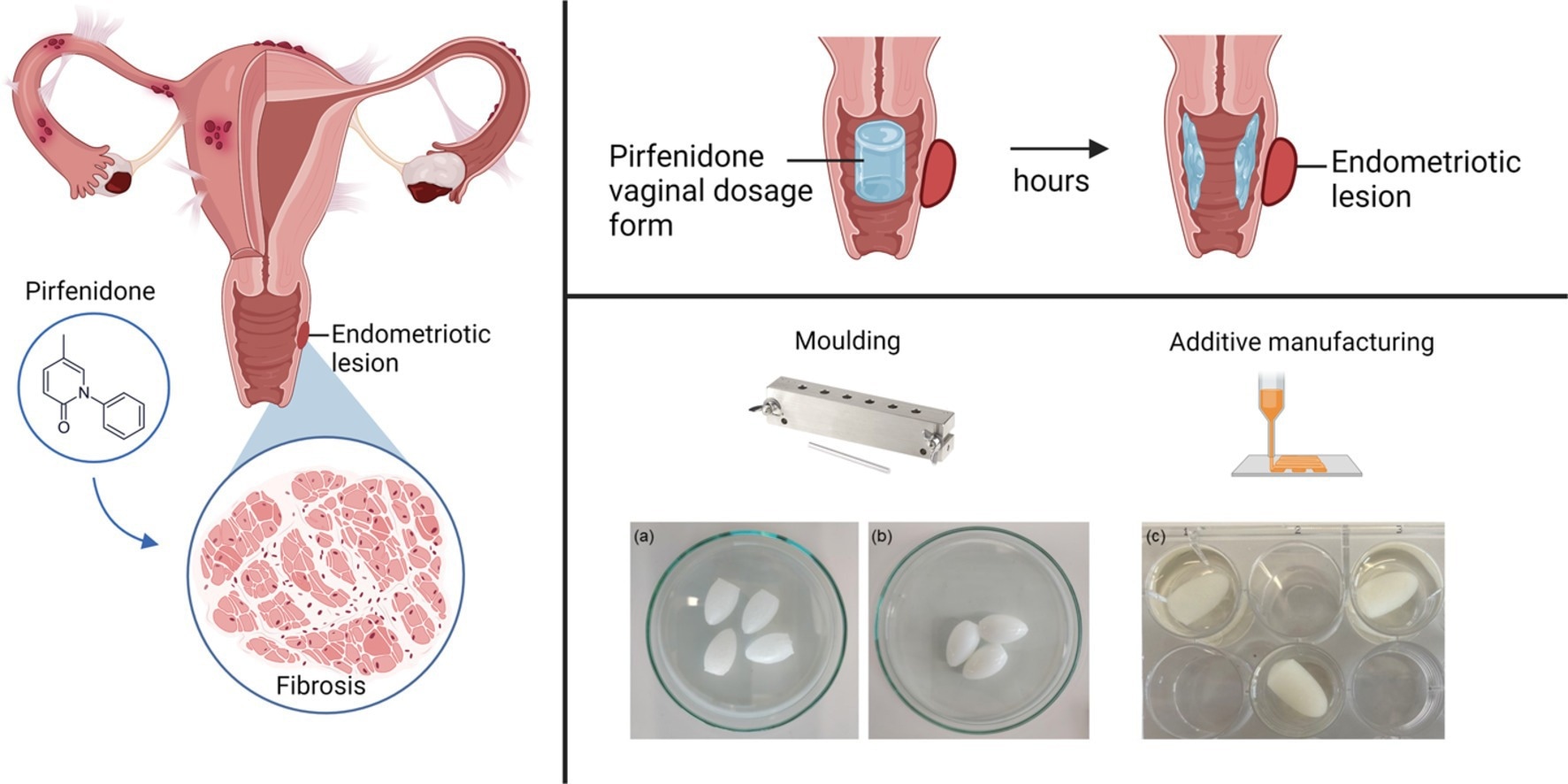 Les ovules vaginaux imprimés en 3D offrent un traitement prometteur ...